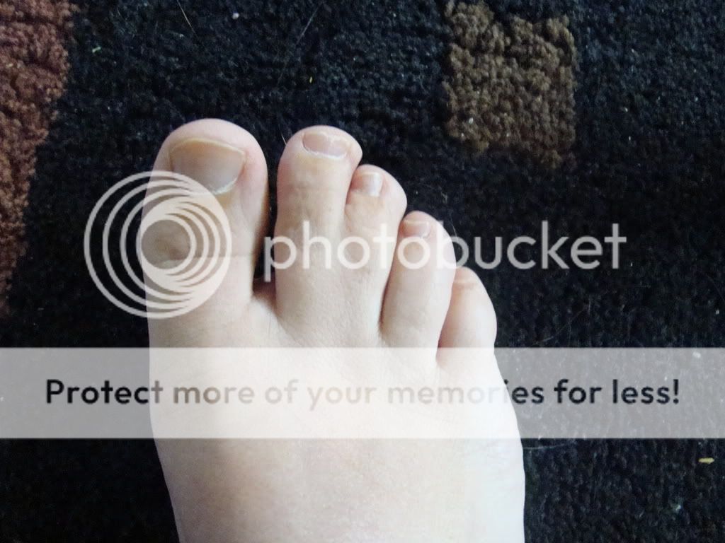 Webbed toes? - BabyCenter
